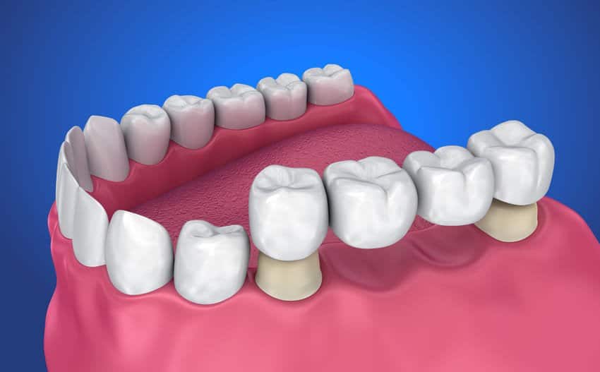 Ponte Dentaria Prótese Dentária Nas Mãos Do Médico Close Up.